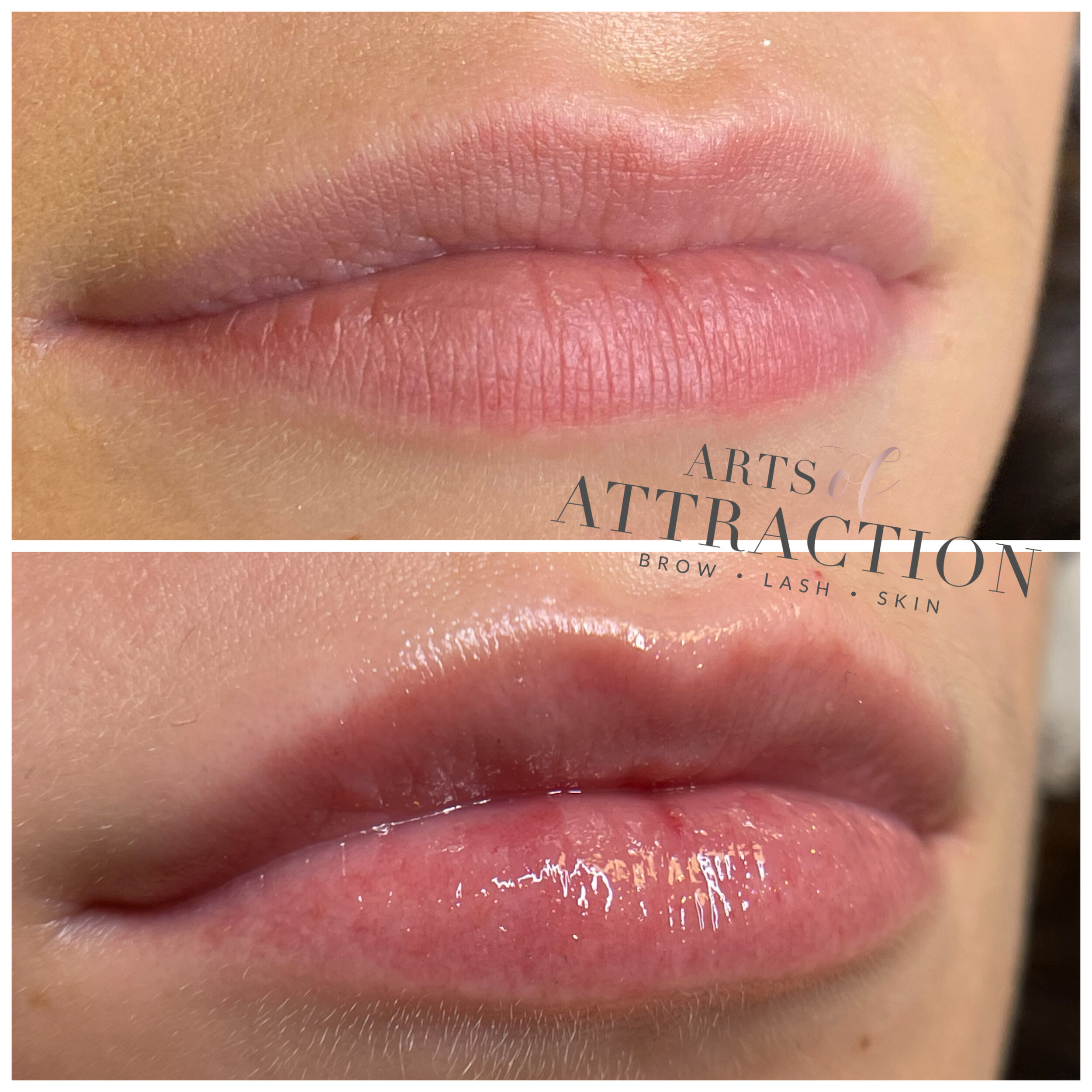 Hyaluronic Lip Infusion - Why Should I Get This? - Arts of Attraction